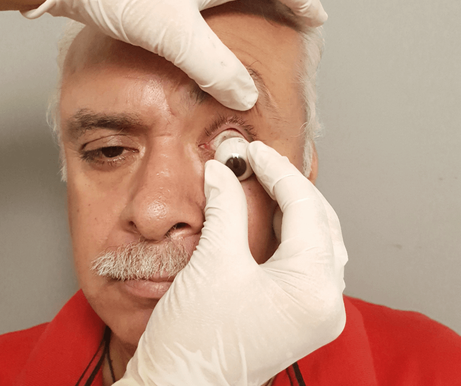 Plásticos Protésicos – Prótesis Oculares en la Ciudad de México