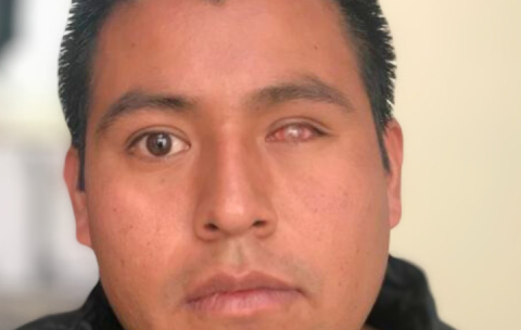 Ptisis bulbi, ¿Qué es y cómo se atiende? - prótesis oculares