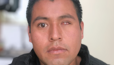 Ptisis bulbi, ¿Qué es y cómo se atiende? - prótesis oculares